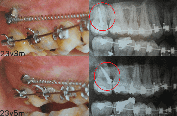 Bio-Ray - A-1 mini Screw - 光哲生技醫療器材有限公司